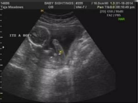 Fetal Age And Gender Determination Pptx