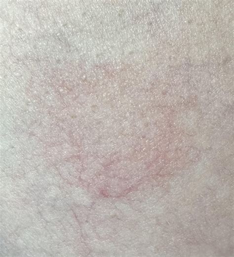 Annular Rashlesion With Central Clearing Rdermatologyquestions