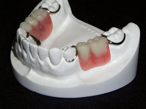 Removable Partial Denture For One Tooth