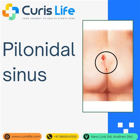 Pilonidal Sinus Surgery In Andheri West Expert Care And Advanced Treatment