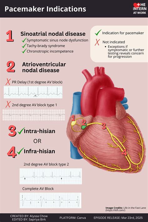 Pacemaker Indications Medicine Pods