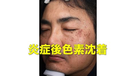 シミ治療をしたらシミができた？ 〜炎症後色素沈着を徹底解説〜 【福岡県福津市】日野皮フ科医院｜皮膚科・美容皮膚科
