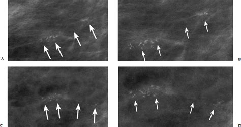 Calcifications Fine Linear Branching Microcalcifications Radiology Key