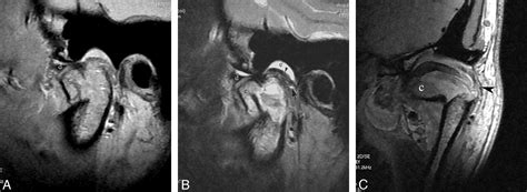 Mr Imaging Assessment Of Temporomandibular Joint Soft Tissue Injuries