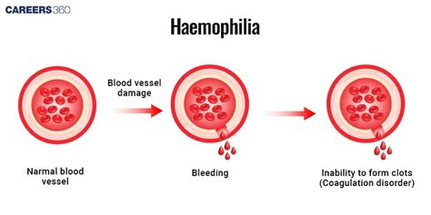 Hemophilia Overview Meaning Causes Types Symptoms Treatment