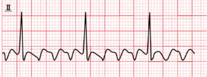 心房粗動 Atrial Flutter AFL プラセボ