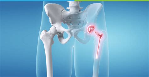 Knee Joint Replacement Archives Dr Suyog Chavhan