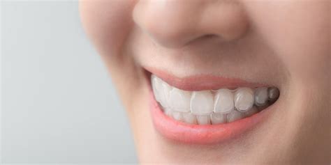 Ceramic Braces Benefits Types Features And Cost In India