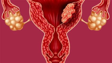 Endometrium Kanseri Genital Estetik