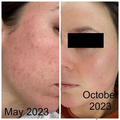 Rosacea Transformation Photos The Rosacea Method Successes
