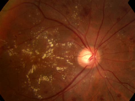 Data Object Detection Model By Retina Dr