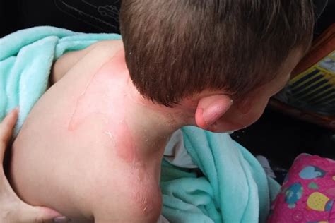 сімя повідомила що їхній дворічний син мав опіки другого ступеня в саду в Боготі Infobae