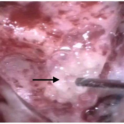 In The Last Step Fibrin Glue Was Used To Seal The Plug The Arrow Download Scientific Diagram
