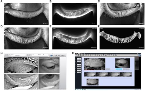 Meibomian Gland Morphology Ocular Surface Interferometer—lipiview Ii Download Scientific