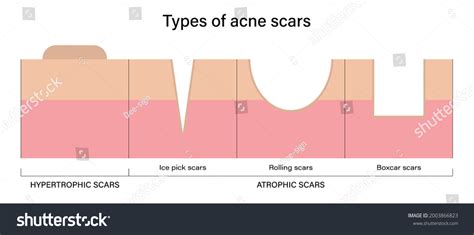 Types Acne Scars Vector Acne Scar Stock Vektor Royaltyfri 2003866823 Shutterstock