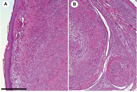 Plexiform Neurofibroma Histopathology