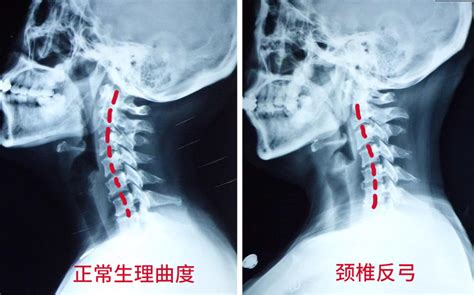 颈椎反弓图片正常颈椎反弓康复训练 伤感说说吧