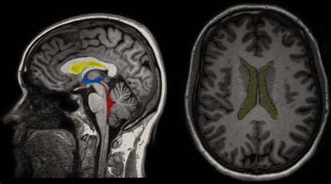 Sagittal Left And Axial Right MR Image Cross Sections Of The Download Scientific Diagram