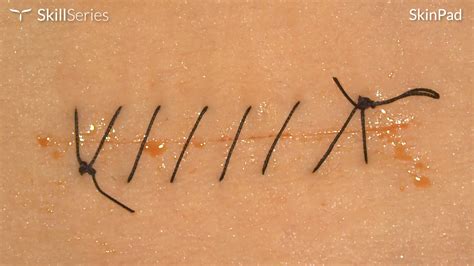 Simple Running Suture Technique How To Master It Upsurgeon