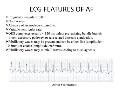 Atrial Fib And Flutter Pptx
