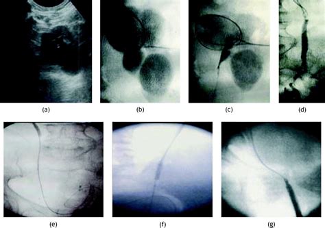 Combined Antegrade And Retrograde Ureteral Stenting The Rendezvous