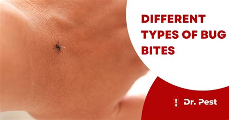 Different Types Of Bug Bites Dr Pest