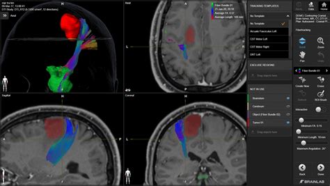Cranial Functional Workflow Treatment Planning Brainlab