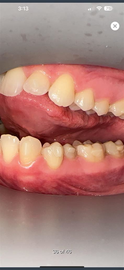 Snaggle Tooth Movement Scrolller