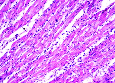 Appearance Of Inflammatory Cell Infiltration In The Myocardium