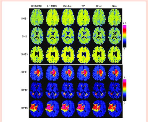 Super Resolution Magnetic Resonance Spectroscopic Imaging Mrsi