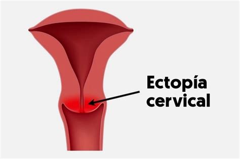 Tratamiento Para Sanar El Ectropión Ectopia Cervical