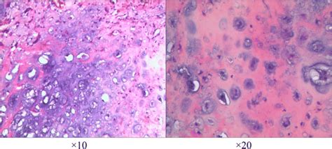 Pathological Characteristics The Pathologic Examination Showed The