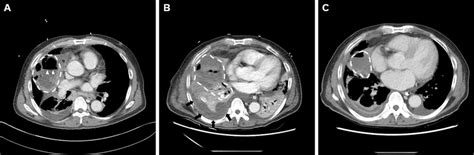 Chest Ct Findings After Lung Abscess Development A A Ct Scan Taken