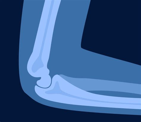 Radiografía Escanear De Codo Articulación Anatómico Estructura