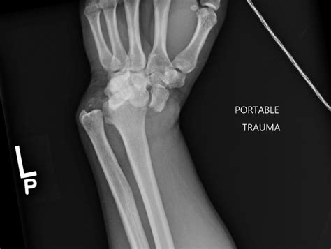 Wrist Dislocation After Motorcycle Crash Sports Medicine Review
