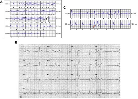 Idiopathic Premature Ventricular Contractiontriggered Ventricular