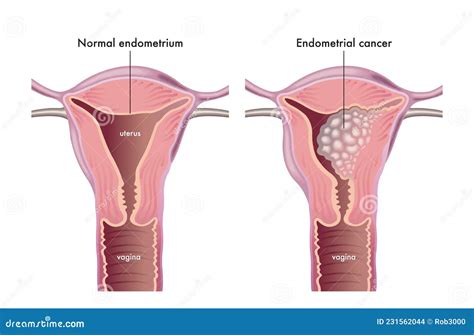 Endometrial Cancer Impact And Social Influence Shown As A Figure In