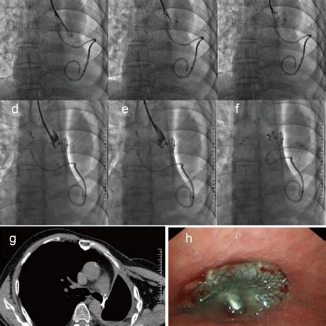 The Process Of Vsd Placement And Follow Up After The Bronchogram The Download Scientific