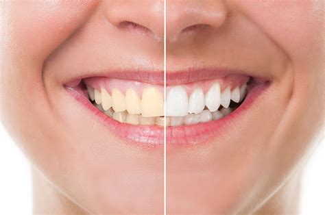 Getting Expert Dental Teeth Cleaning Dental Care Of North Florida