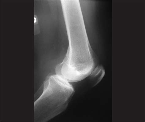 Radiografia Do Joelho Esquerdo Perfil Normal Download Scientific