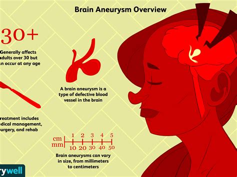 How To Detect A Brain Aneurysm Sellsense23