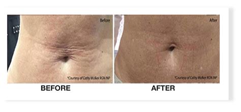 Profhilo Injection Treatment