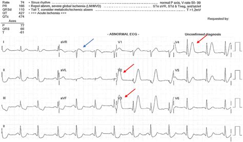 Anterior Myocardial Infarction Litfl Ecg Library