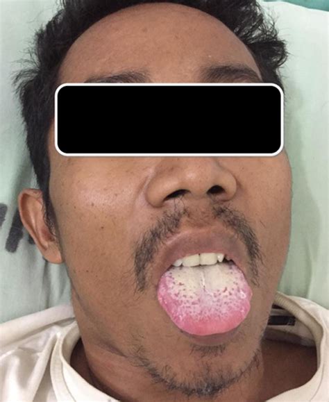 Oral Thrush Hiv