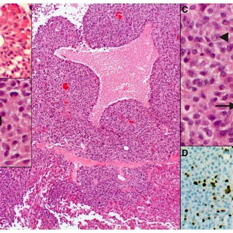 Pituitary Tumor Arranged In Sheets Of Pleomorphic Epithelial Cells