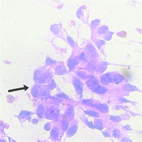 Photomicrograph Of Tonsil Showing Invasive Cluster Of Tumor Cells Of