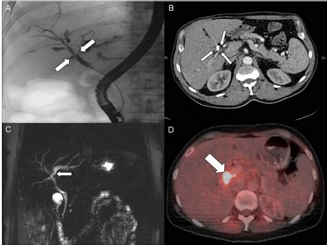 A Endoscopic Retrograde Cholangiopancreatography Ercp Showing A