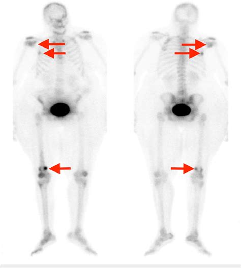 Nm Bone Scan Showing Metastasis Arrows In The Right Glenoid Right