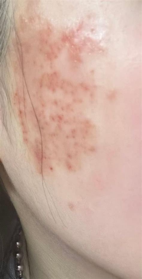 얼굴에 붉은반점 가려움 진물 지식in