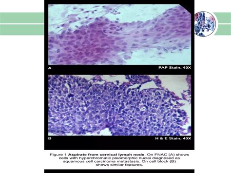 Cell Block In Cytology Ppt